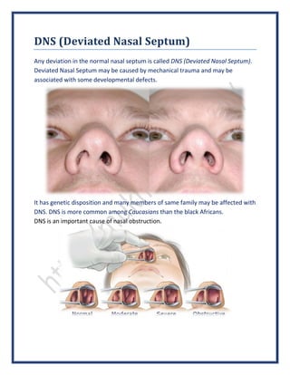 Deviated Nasal Septum Types