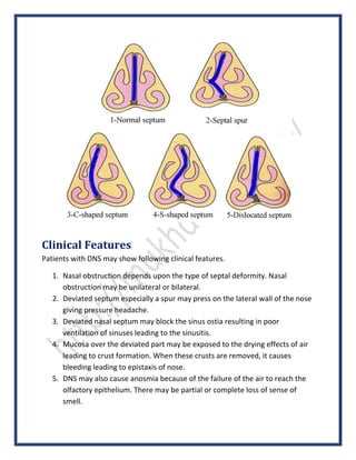 Dns (Deviated Nasal Septum) | SurgicoMed.com