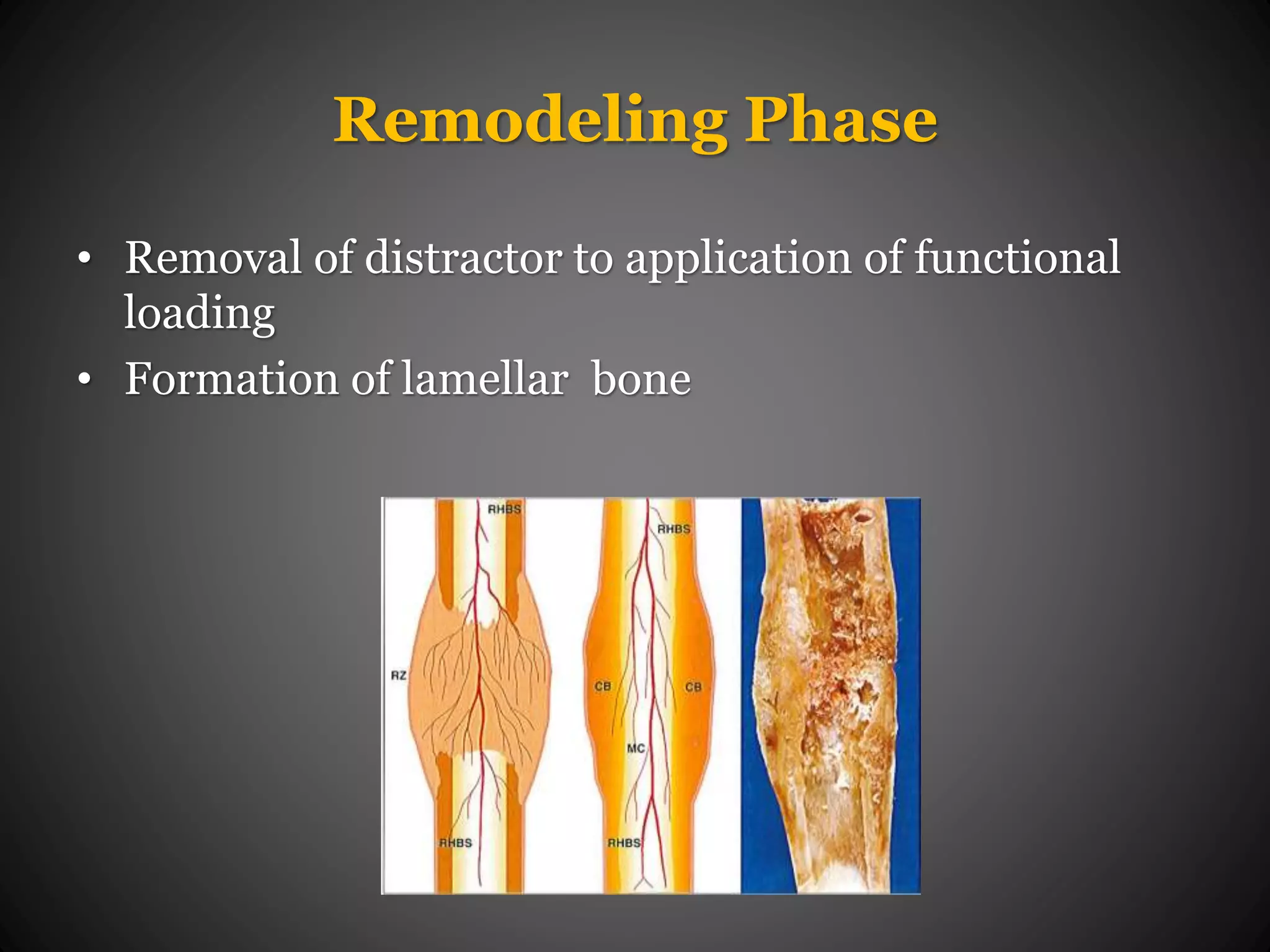 Distraction Osteogenesis in Orthodontics | PPTX