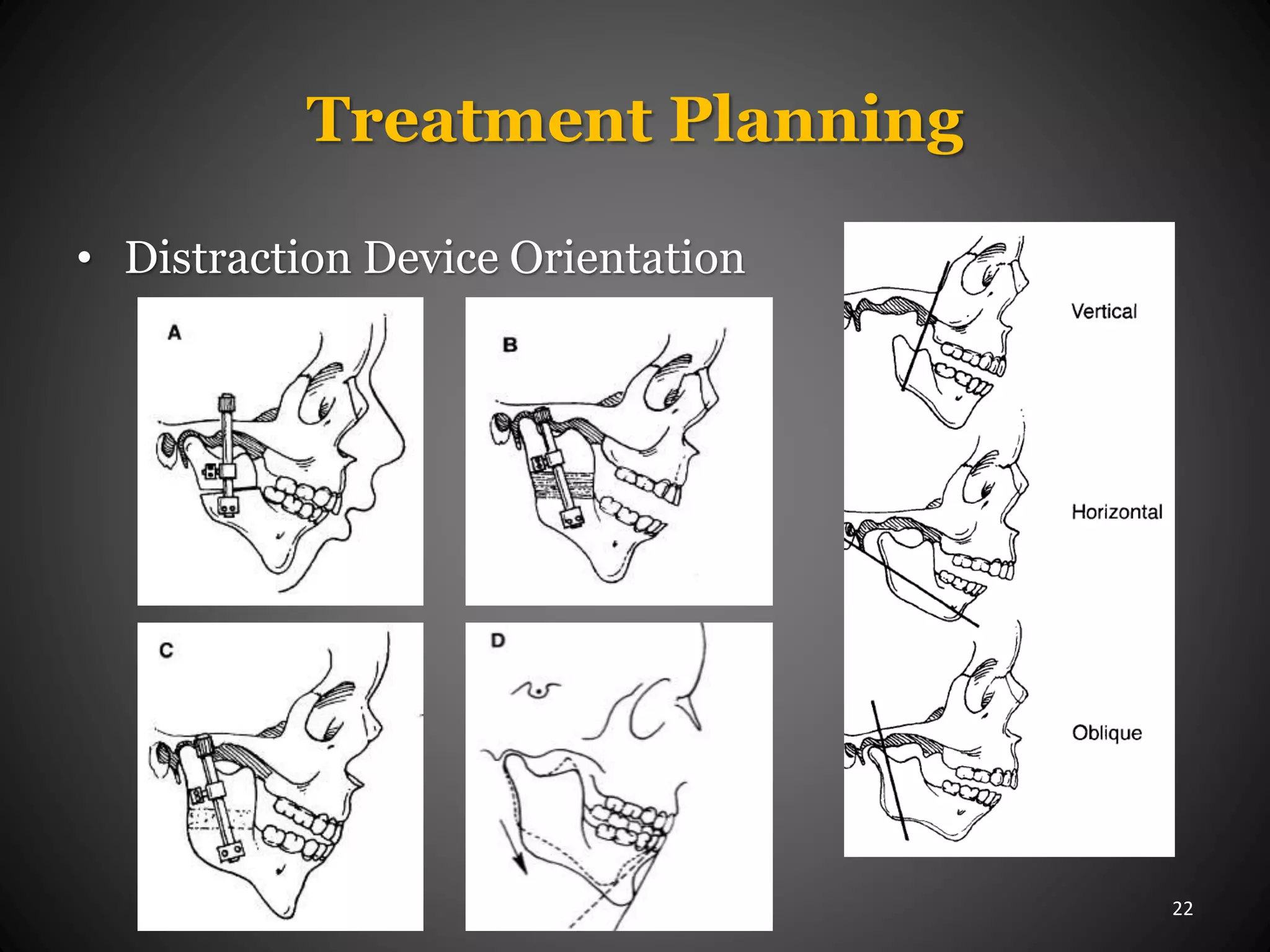Distraction Osteogenesis in Orthodontics | PPTX