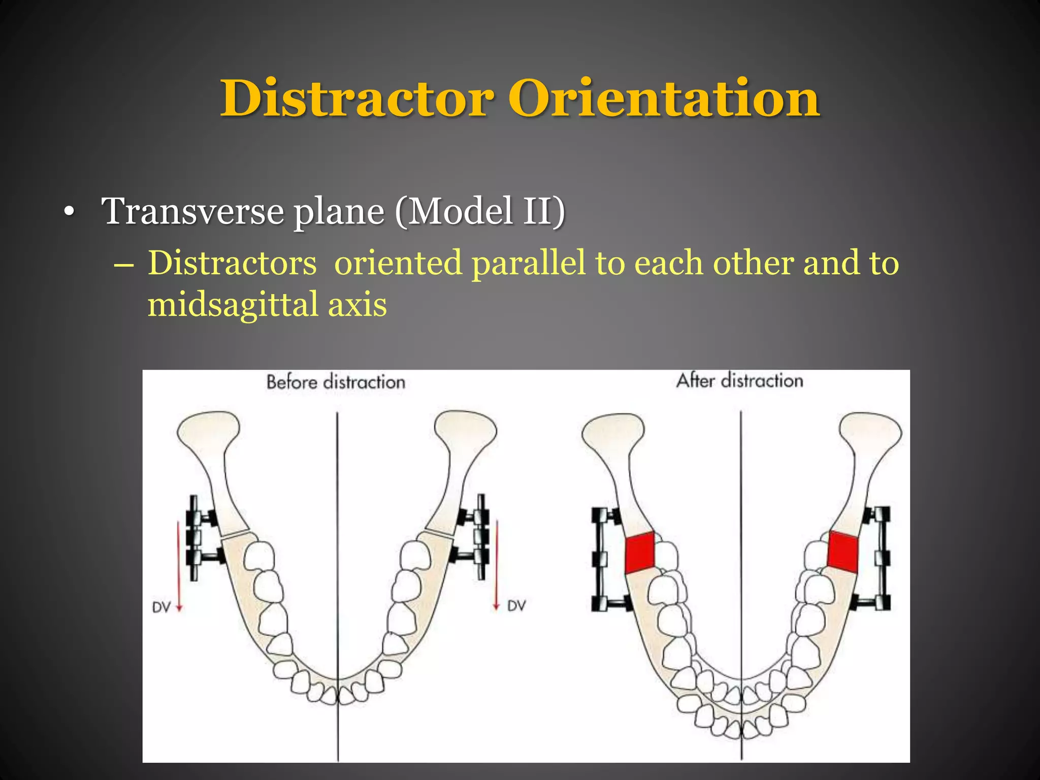 Distraction Osteogenesis in Orthodontics | PPTX