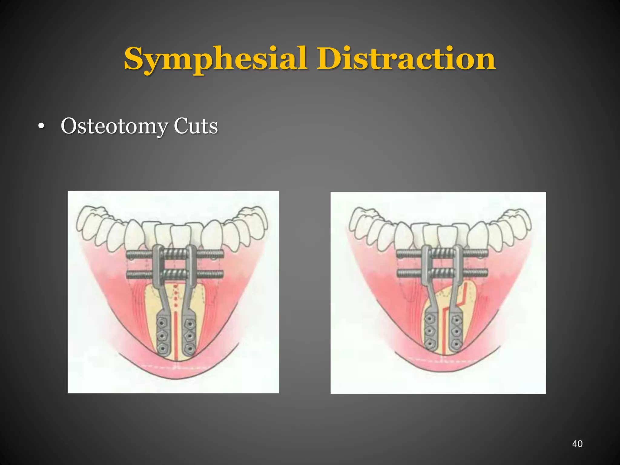 Distraction Osteogenesis in Orthodontics | PPTX