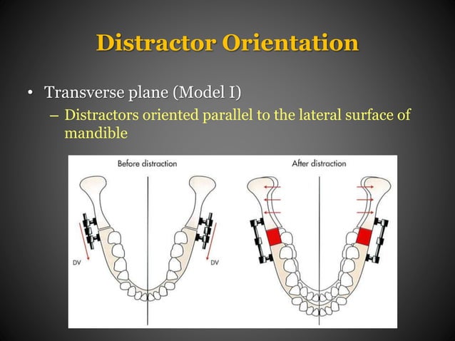 Distraction Osteogenesis in Orthodontics | PPTX