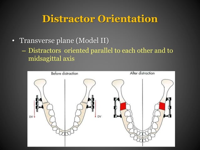Distraction Osteogenesis in Orthodontics | PPTX