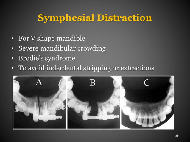 Distraction Osteogenesis in Orthodontics | PPTX