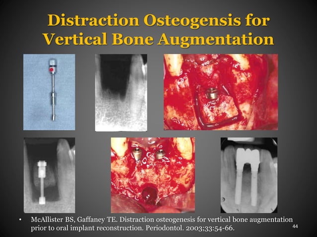 Distraction Osteogenesis in Orthodontics | PPTX