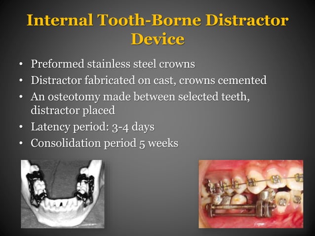 Distraction Osteogenesis In Orthodontics