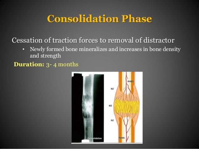 Distraction Osteogenesis in Orthodontics