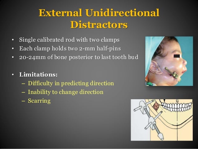 Distraction Osteogenesis in Orthodontics