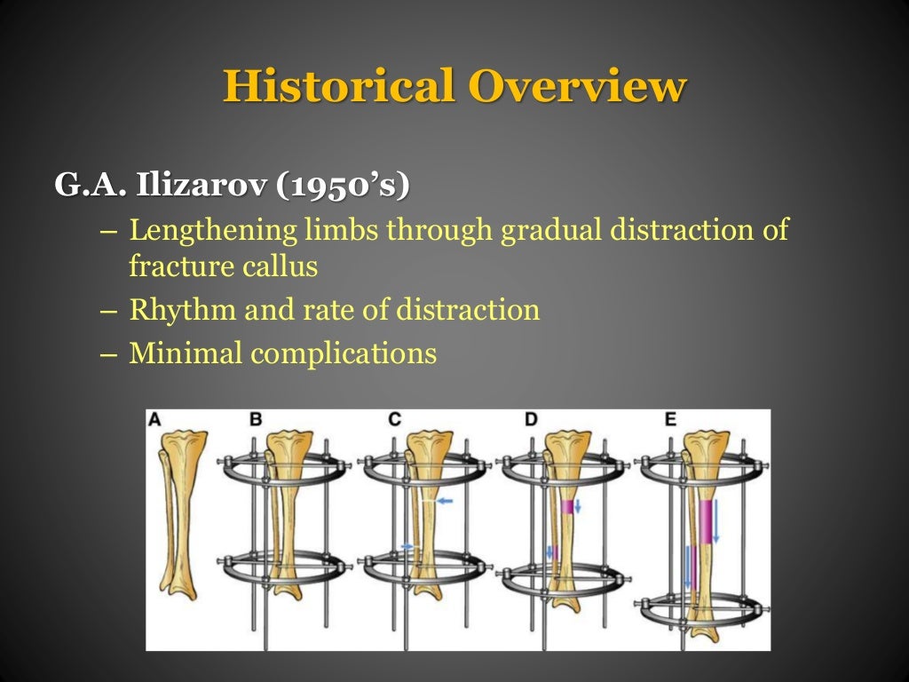 Distraction Osteogenesis in Orthodontics