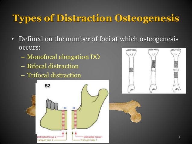 Distraction Osteogenesis in Orthodontics