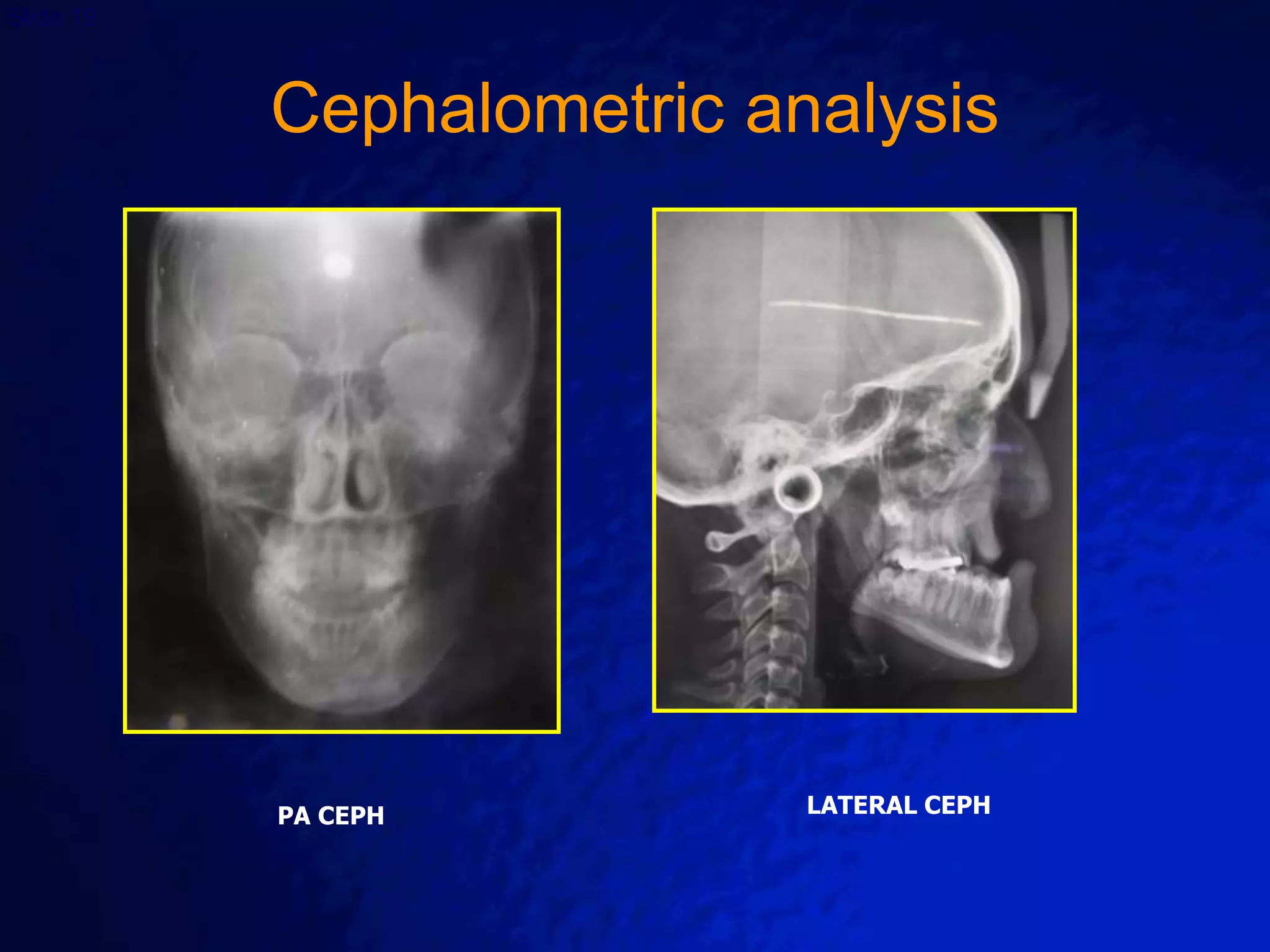 Distraction Osteogenesis of Craniofacial Region | PPTX