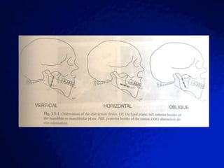 Distraction Osteogenesis of Craniofacial Region | PPTX