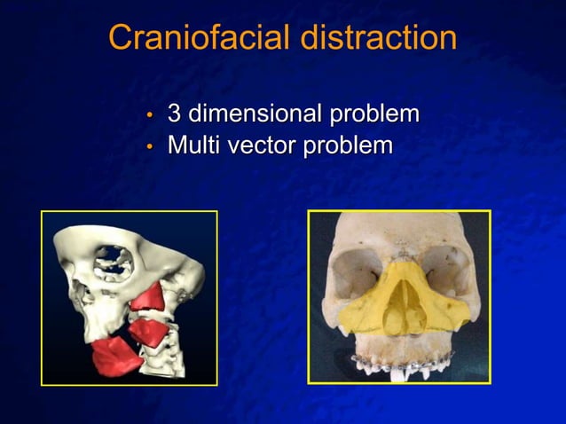 Distraction Osteogenesis of Craniofacial Region | PPT