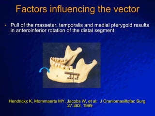Distraction Osteogenesis of Craniofacial Region | PPTX
