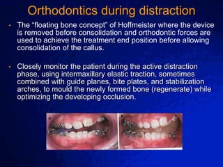 Distraction Osteogenesis of Craniofacial Region | PPTX