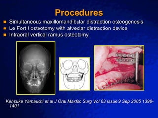 Distraction Osteogenesis of Craniofacial Region | PPTX