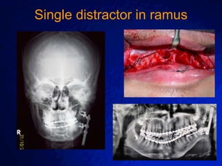 Distraction Osteogenesis of Craniofacial Region | PPTX