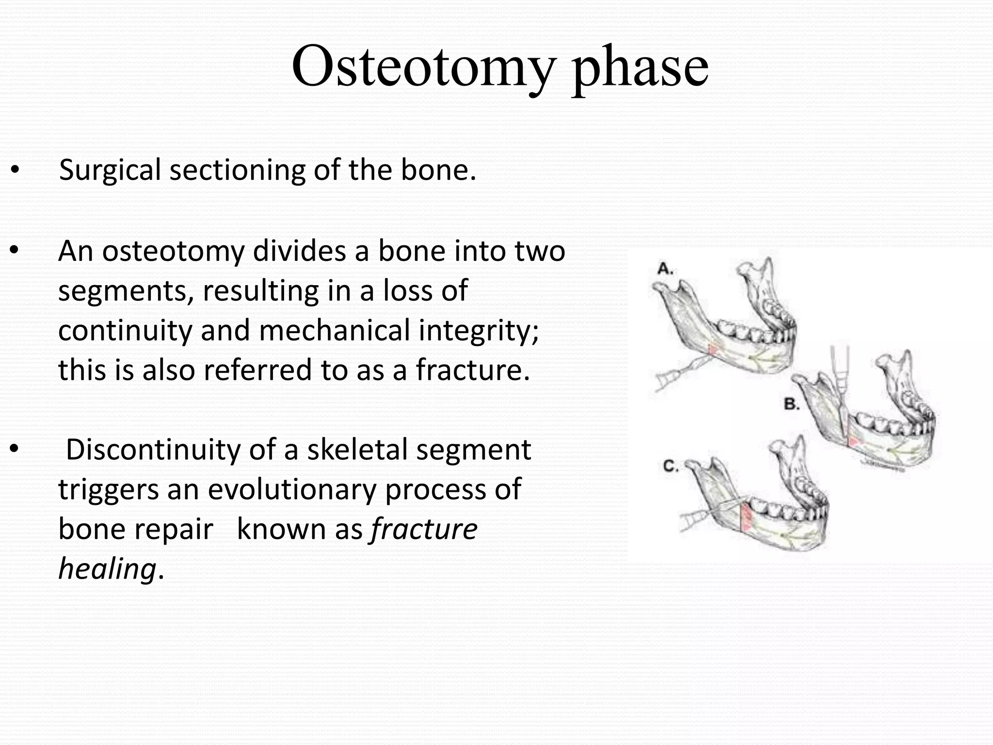 Distraction Osteogenesis | PPTX