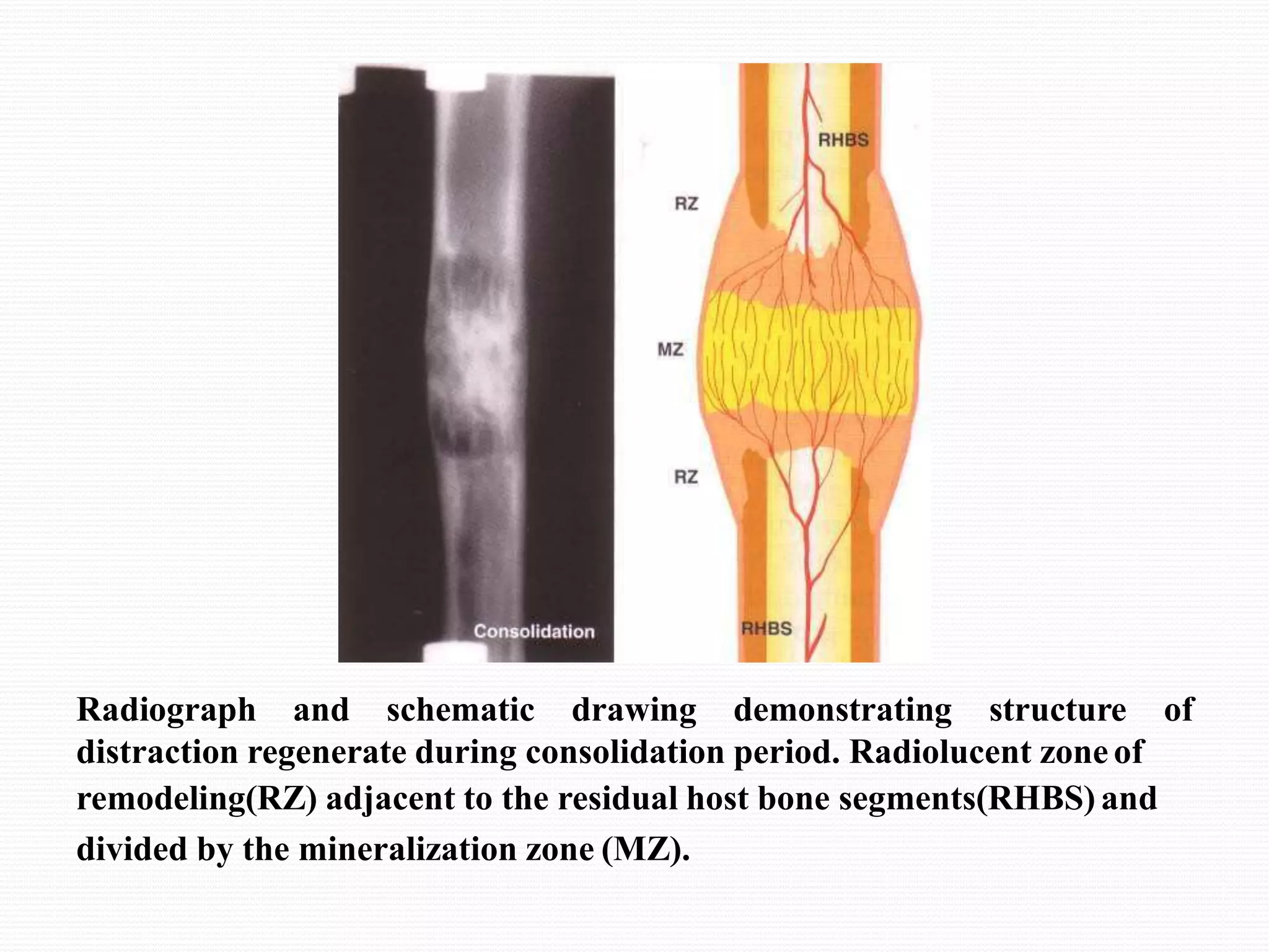 Distraction Osteogenesis | PPTX