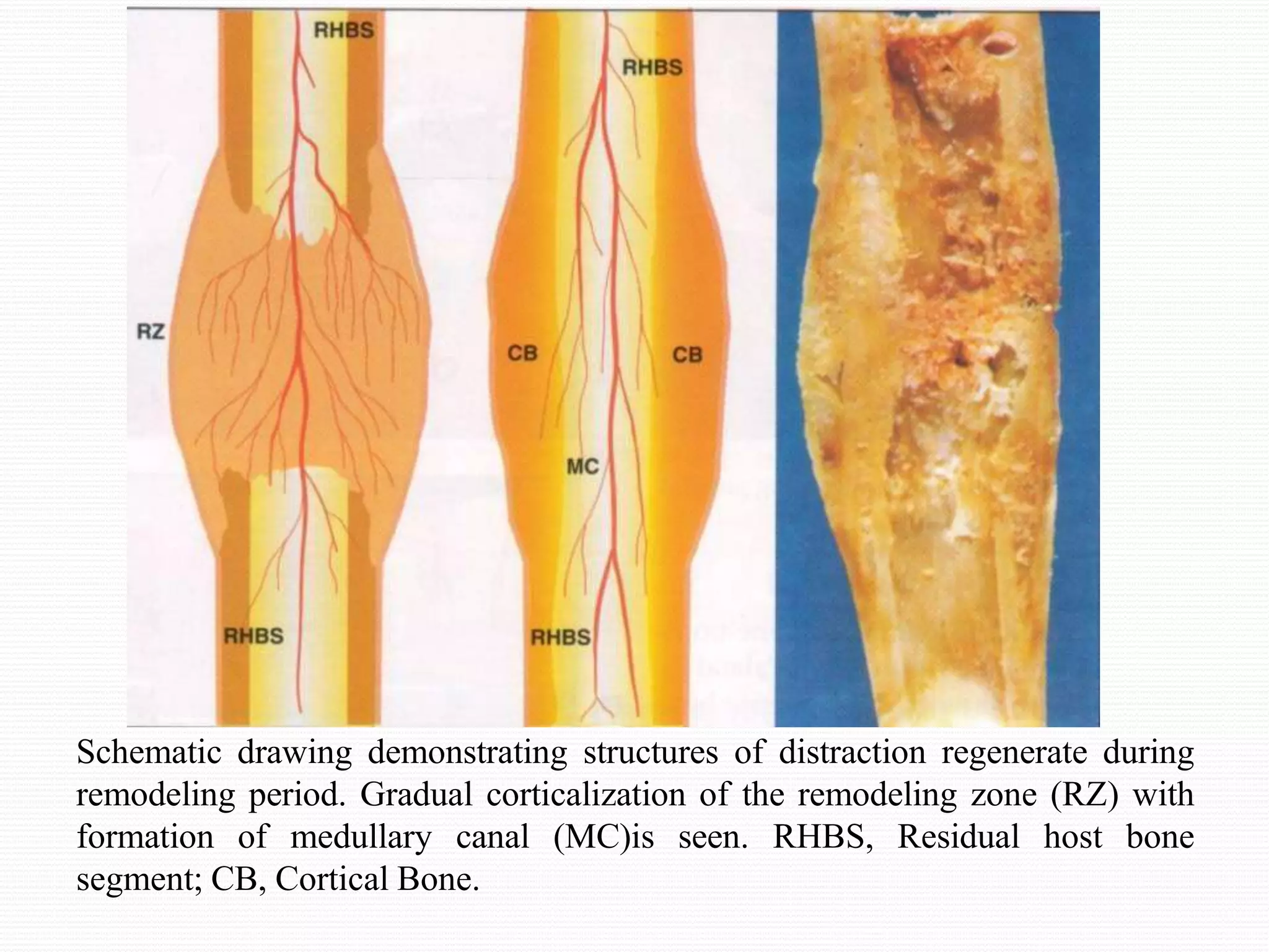 Distraction Osteogenesis | PPTX