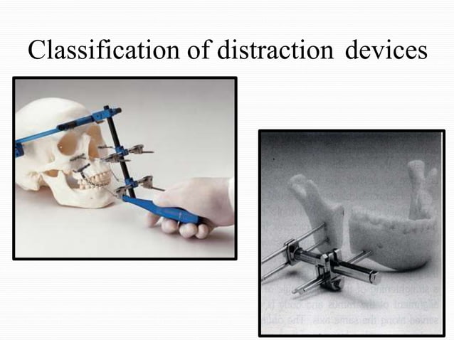 Distraction Osteogenesis
