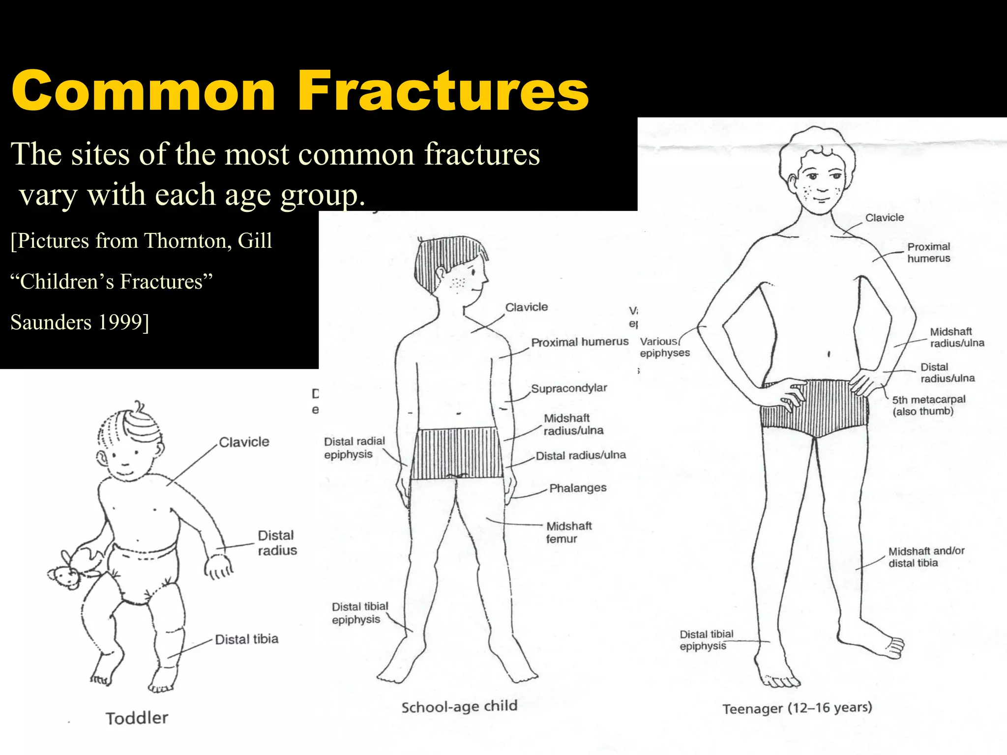 Do it-yourself-paeds-ortho (Paediatric Orthopaedics for beginners) | PPT