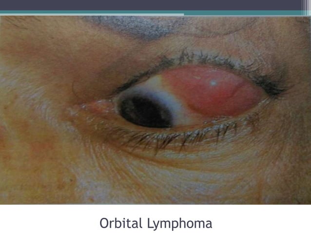 PROPTOSIS | PPTX | Ear, Nose and Throat Conditions | Diseases and ...