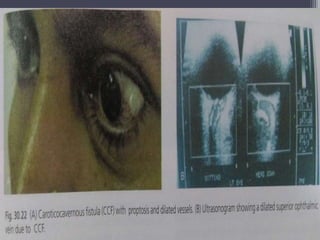 PROPTOSIS | PPTX | Ear, Nose and Throat Conditions | Diseases and ...