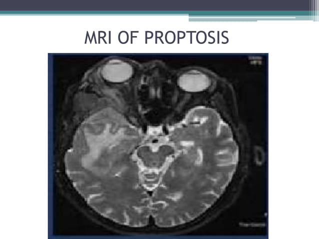 PROPTOSIS | PPTX | Ear, Nose and Throat Conditions | Diseases and ...