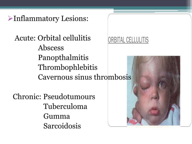 PROPTOSIS | PPTX | Ear, Nose and Throat Conditions | Diseases and ...