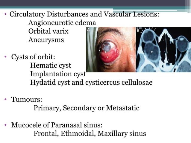PROPTOSIS | PPTX | Ear, Nose and Throat Conditions | Diseases and ...