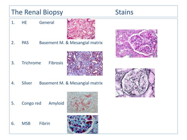renal biopsy | PPT
