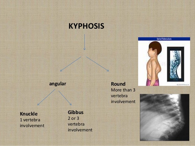 koch's spine