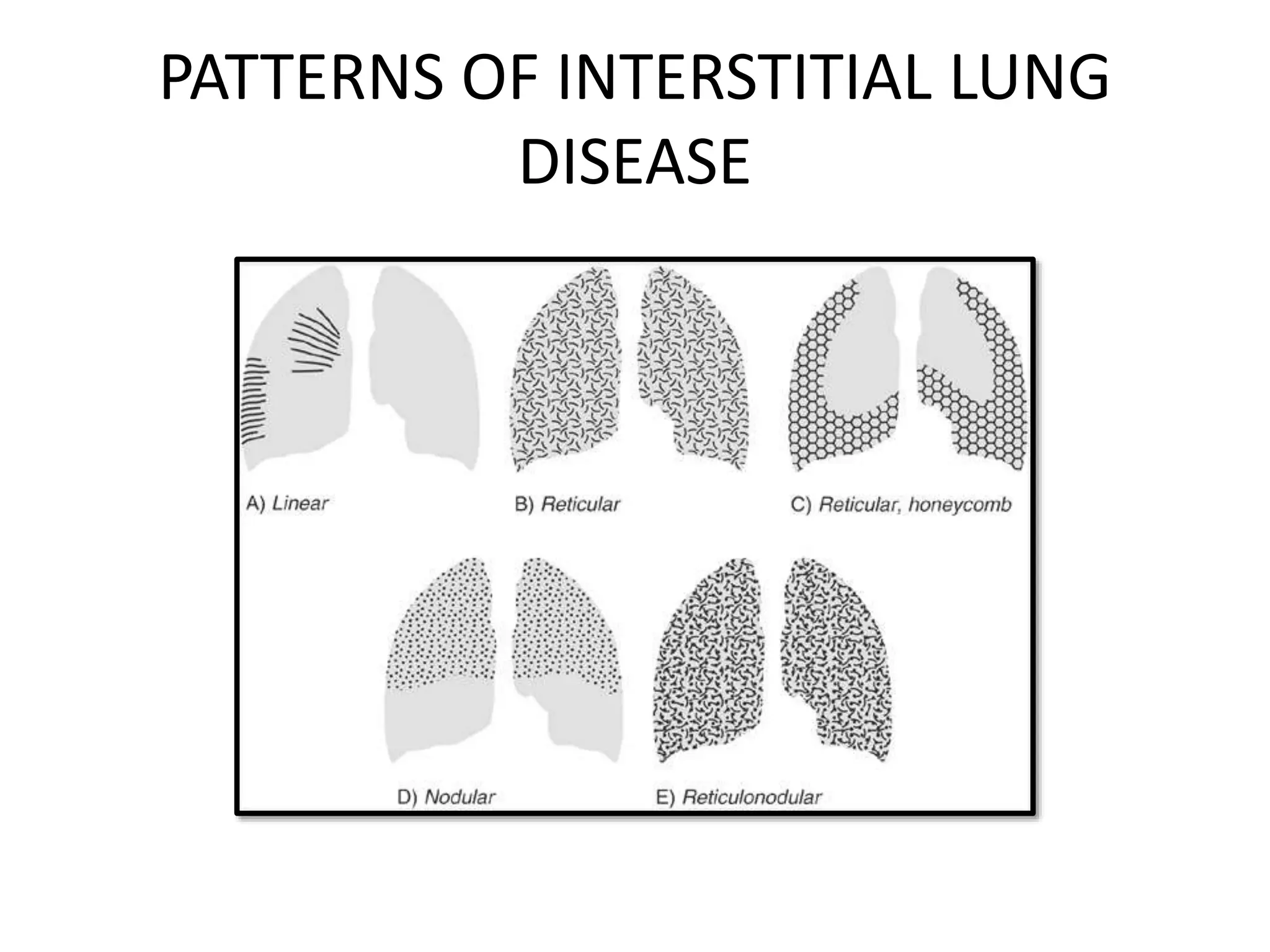 Interstitial Lung Diseases Ppt