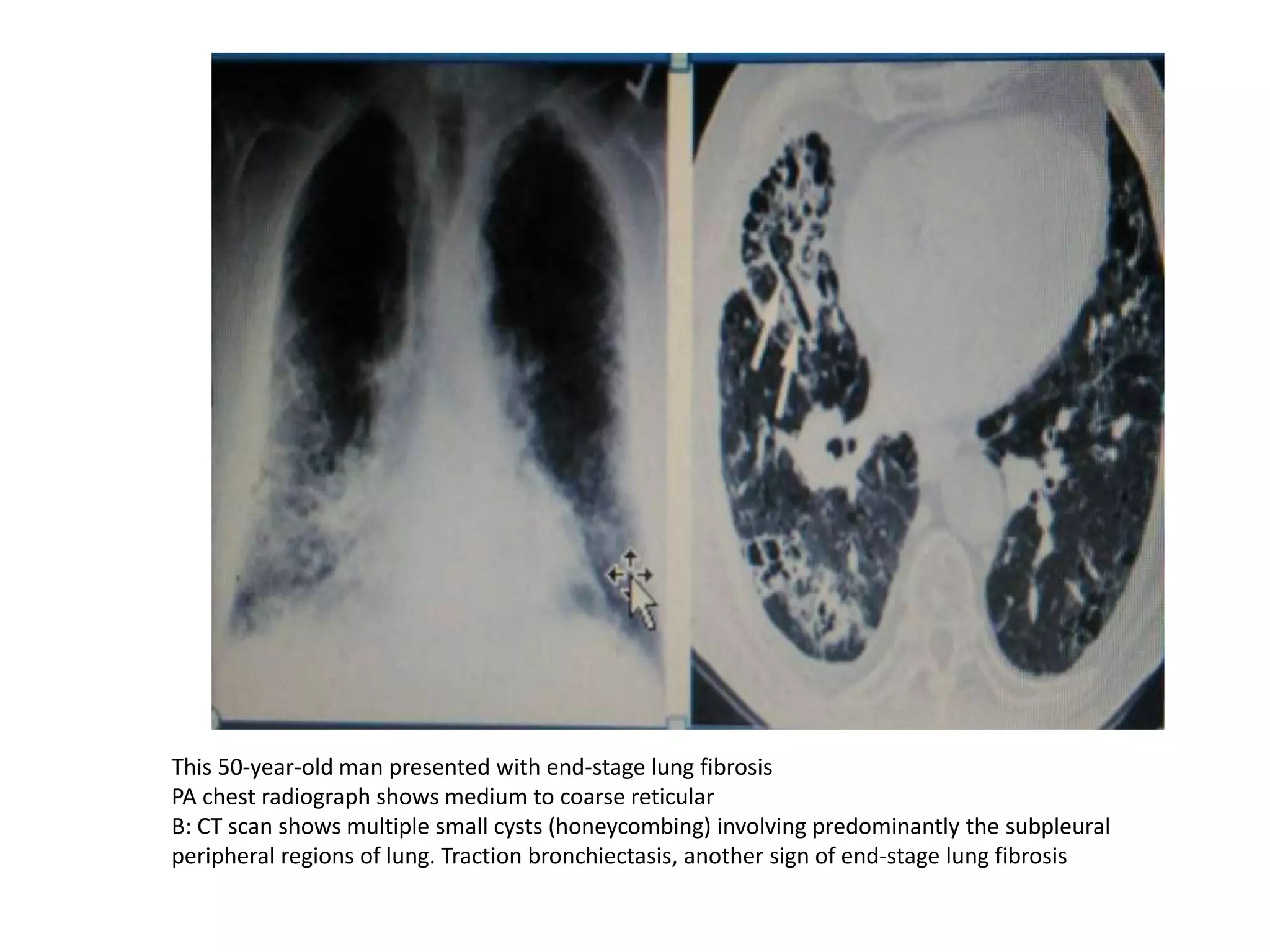 interstitial lung diseases | PPTX