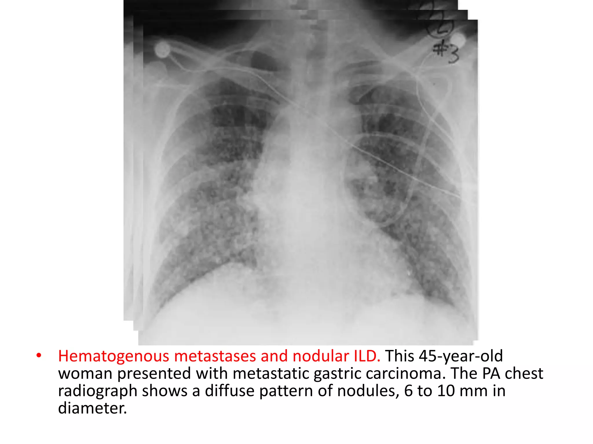 interstitial lung diseases | PPTX
