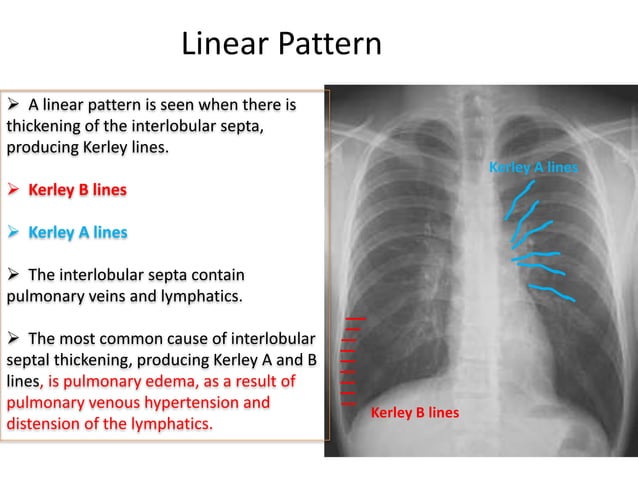 interstitial lung diseases | PPTX