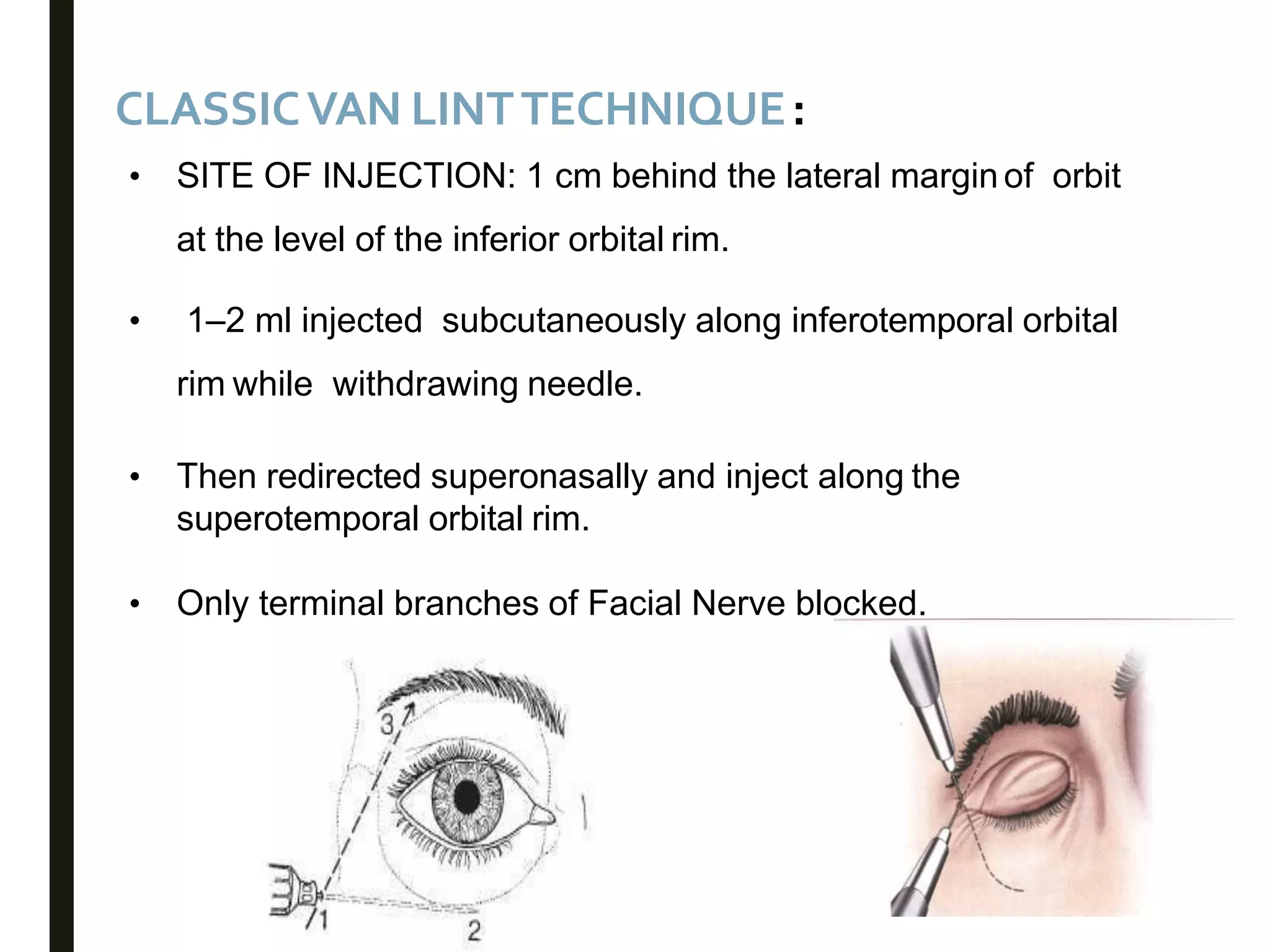 Ocular anesthesia | PPTX