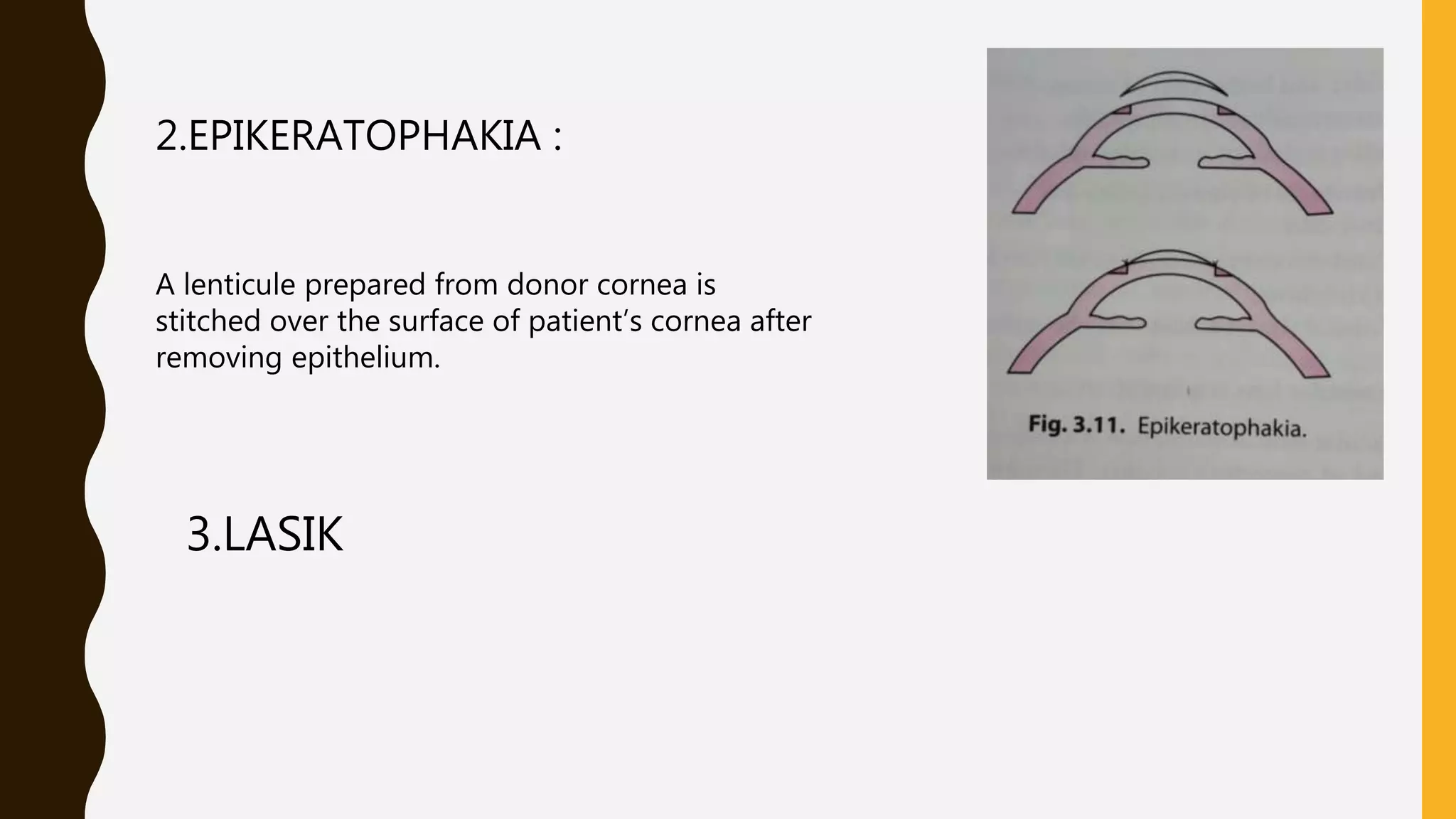 Aphakia | PPTX
