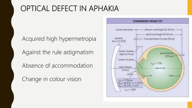 Aphakia | PPTX | Death, Injury, or Military Conflict | Sensitive Topics