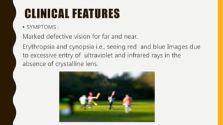Aphakia | PPTX