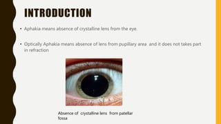Aphakia | PPTX