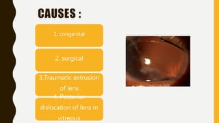 Aphakia | PPTX