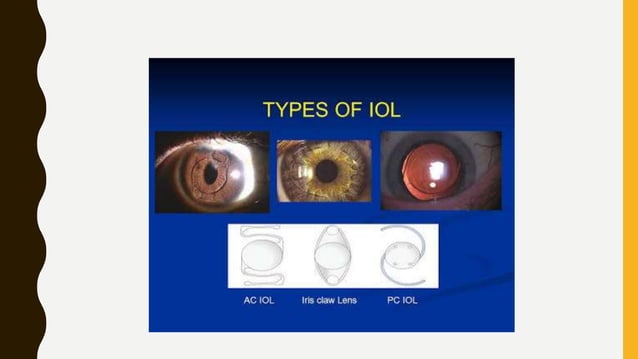 Aphakia | PPTX | Death, Injury, or Military Conflict | Sensitive Topics