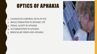 Aphakia | PPTX