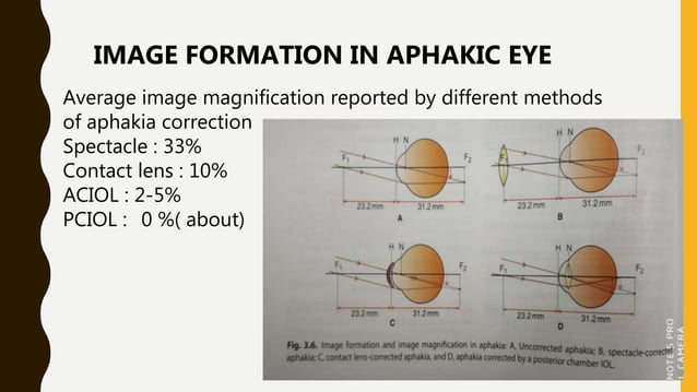 Aphakia | PPTX | Death, Injury, or Military Conflict | Sensitive Topics