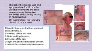 Hemoptysis - a case-based discussion | PPT