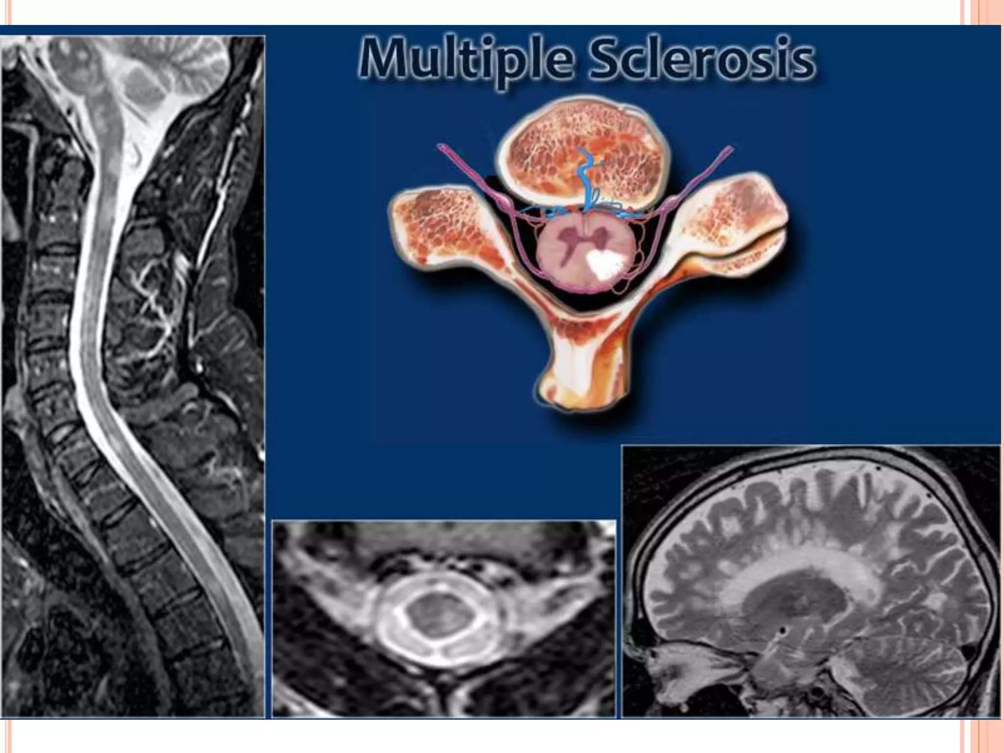 Spinal Cord Lesions And Its Radiological Imaging Finding Pptx