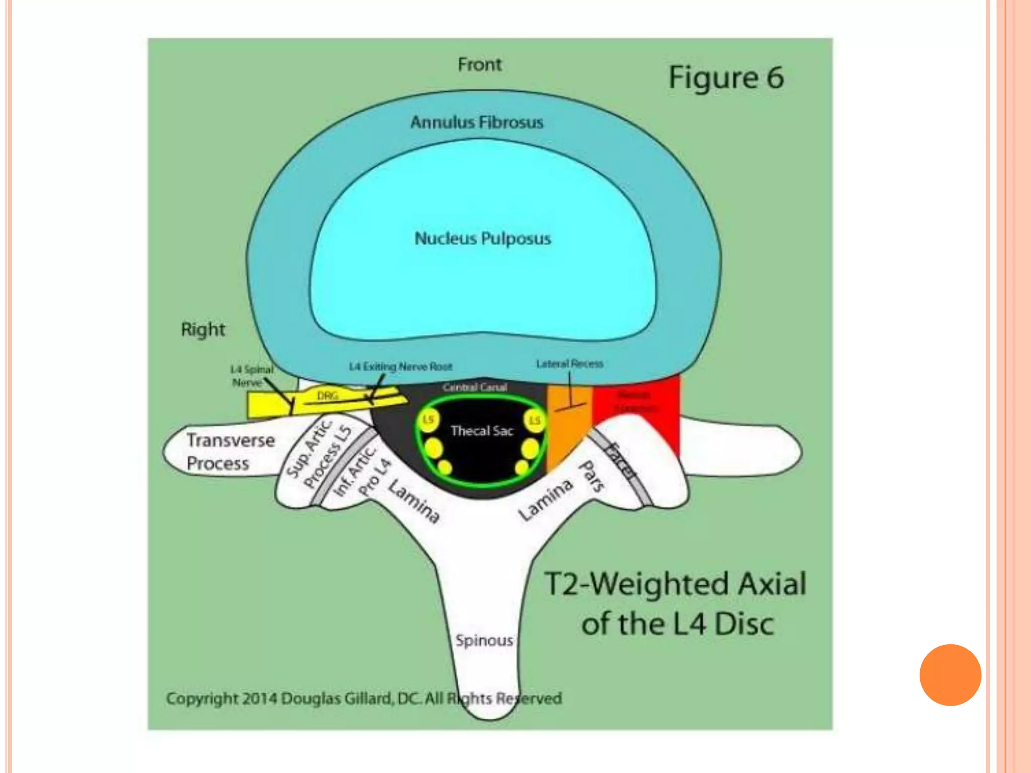 Spinal cord lesions and its radiological imaging finding. | PPTX
